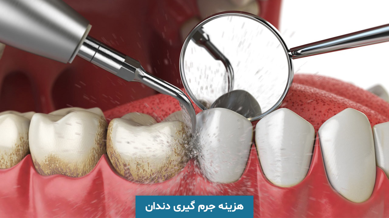 هزینه جرم گیری دندان در سال 1404 چقدر است؟ - implantdr