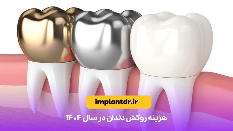 هزینه روکش دندان در سال 1404 با پوشش درمانی بیمه - implantdr
