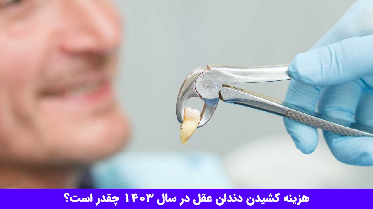 هزینه کشیدن دندان عقل در سال 1404 چقدر است؟ - implantdr